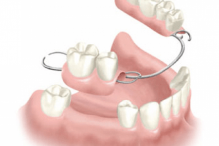 Próteses Dentárias, Fixa,Removível- Dr. Gabriel Campolongo